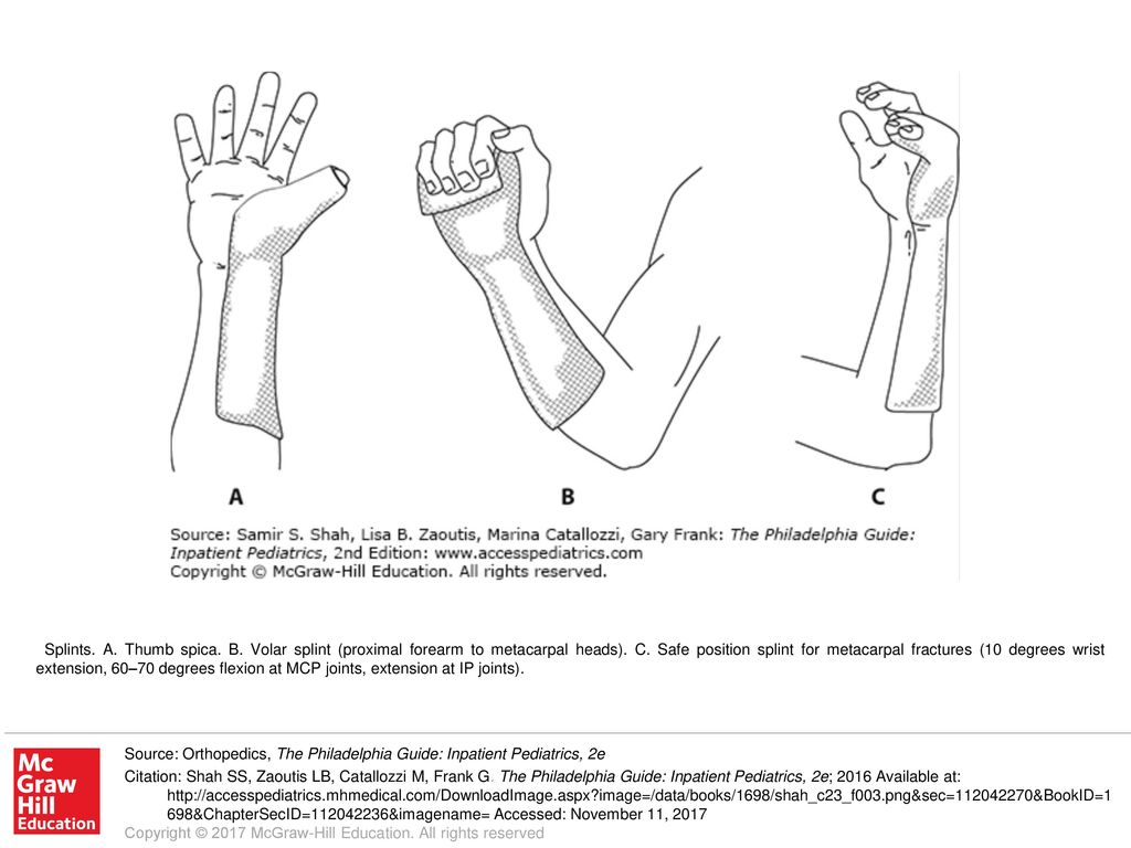 Volar Finger Splint