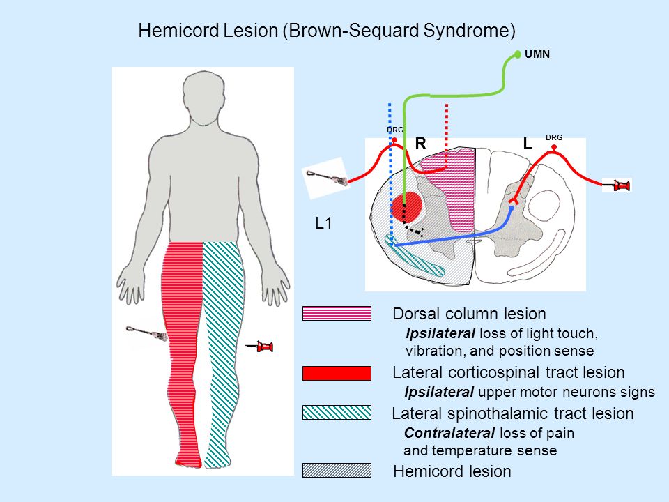 PARAPLEGIA AND SPINAL CORD SYNDROMES - ppt video online download