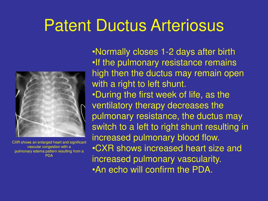 Patent Ductus Arteriosus X Ray