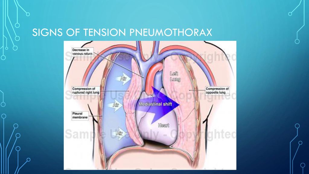 Tension Pneumothorax Ppt Download