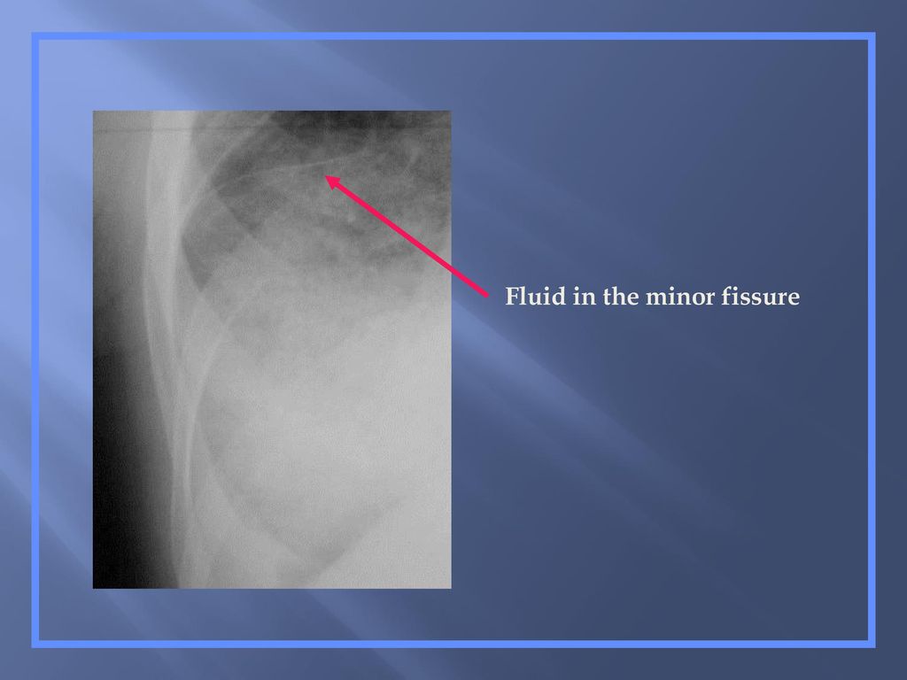 Chest Imaging Introduction Ppt Download