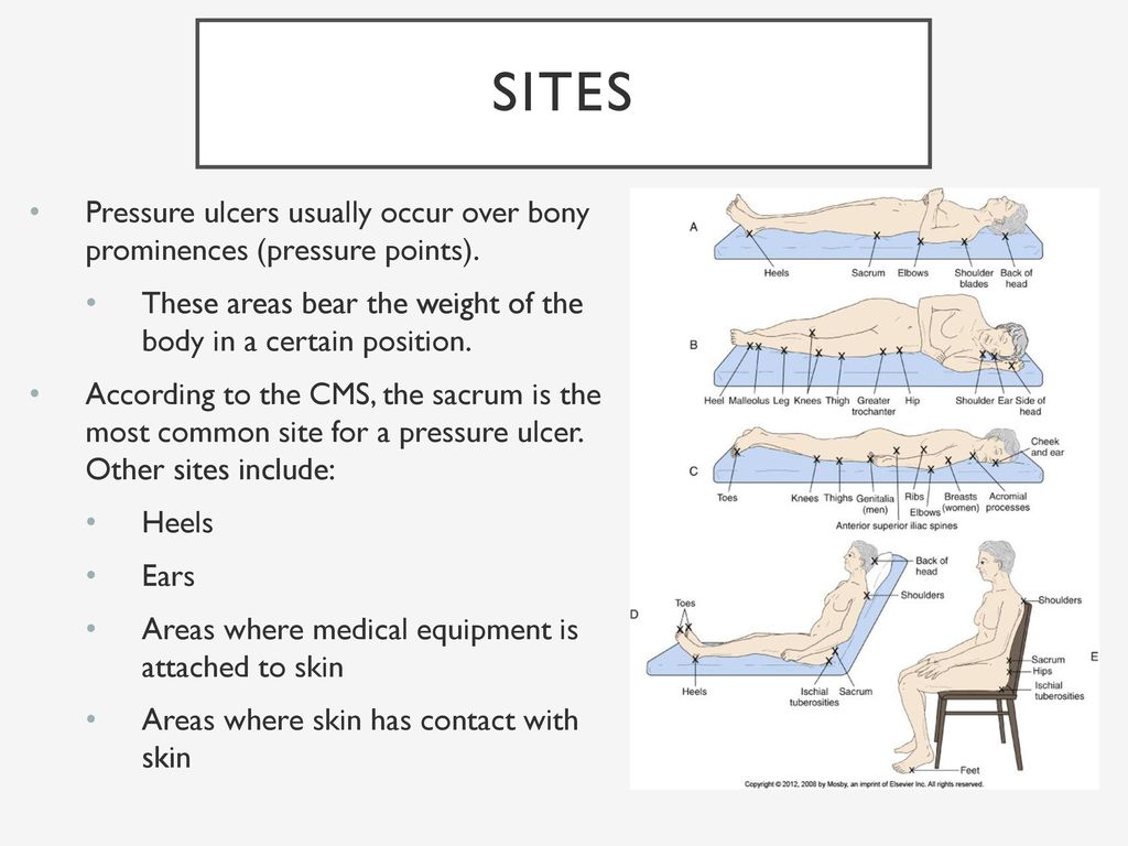 Pressure Ulcer Points
