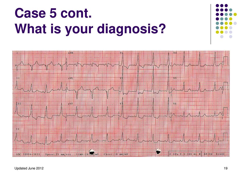 Syncope A Symptom Not A Diagnosis… Clinical Cases Ppt Download