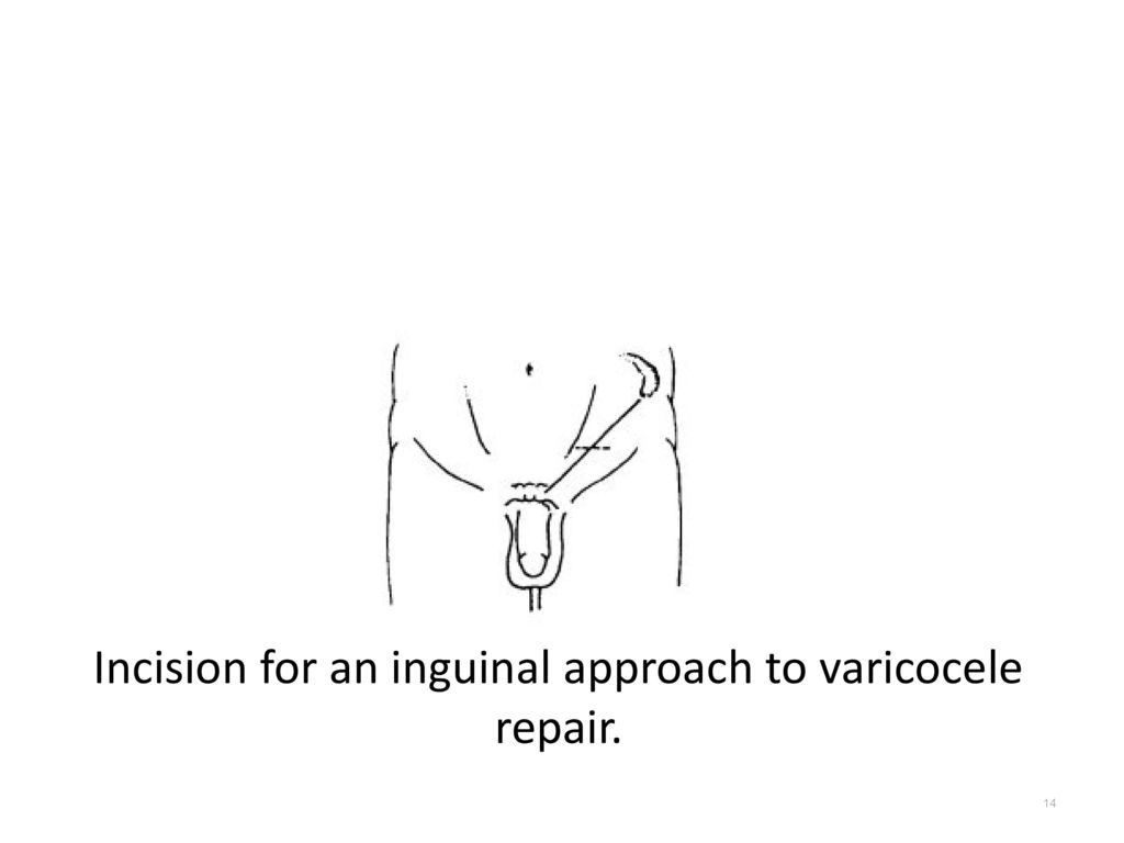 Varicocele Ppt Download