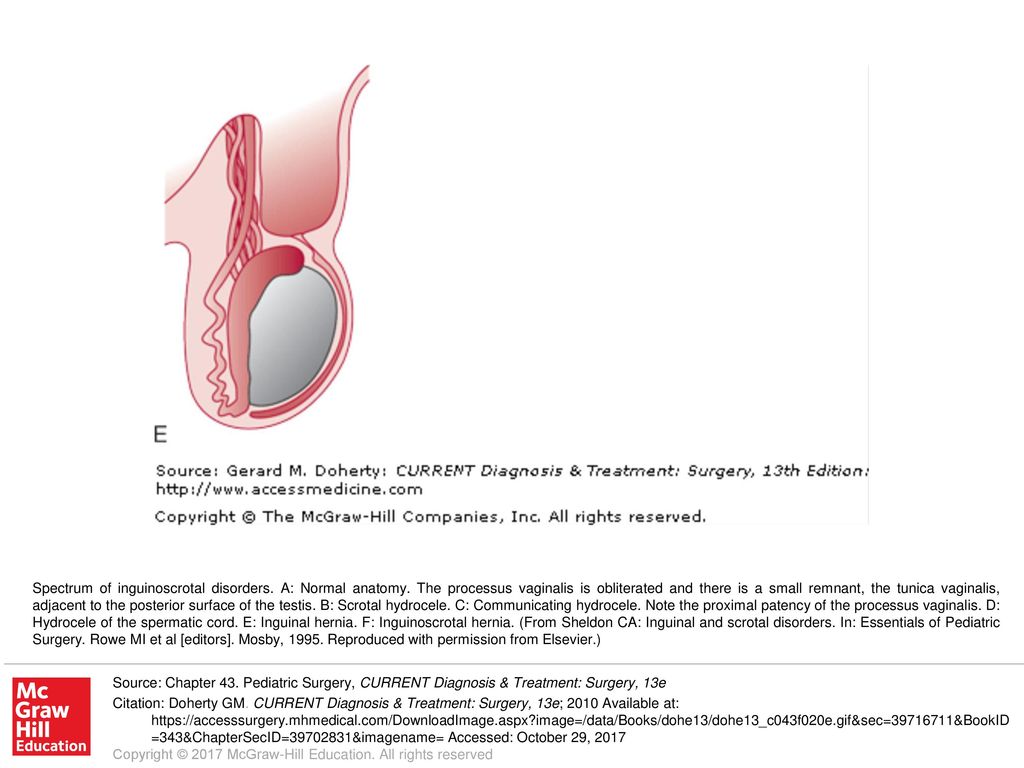 Spectrum Of Inguinoscrotal Disorders A Normal Anatomy Ppt Download