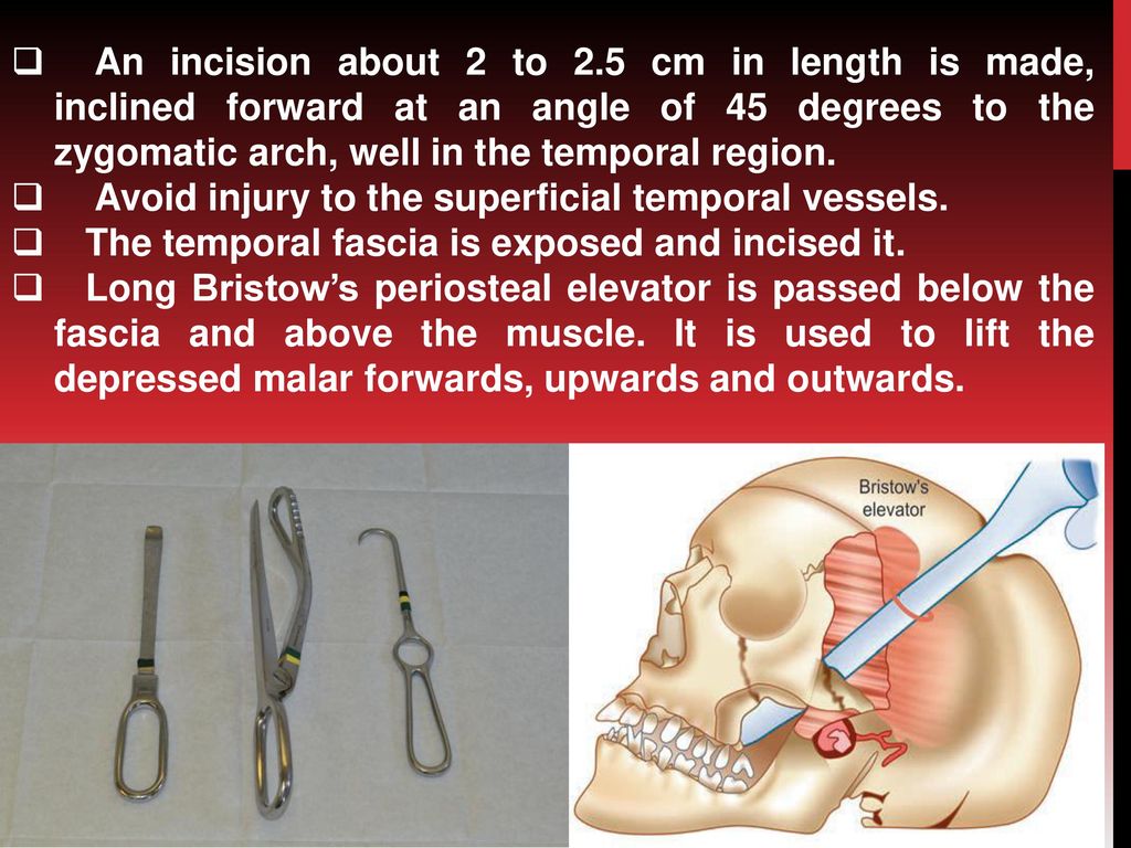 Zygomatic Arch Fracture Treatment