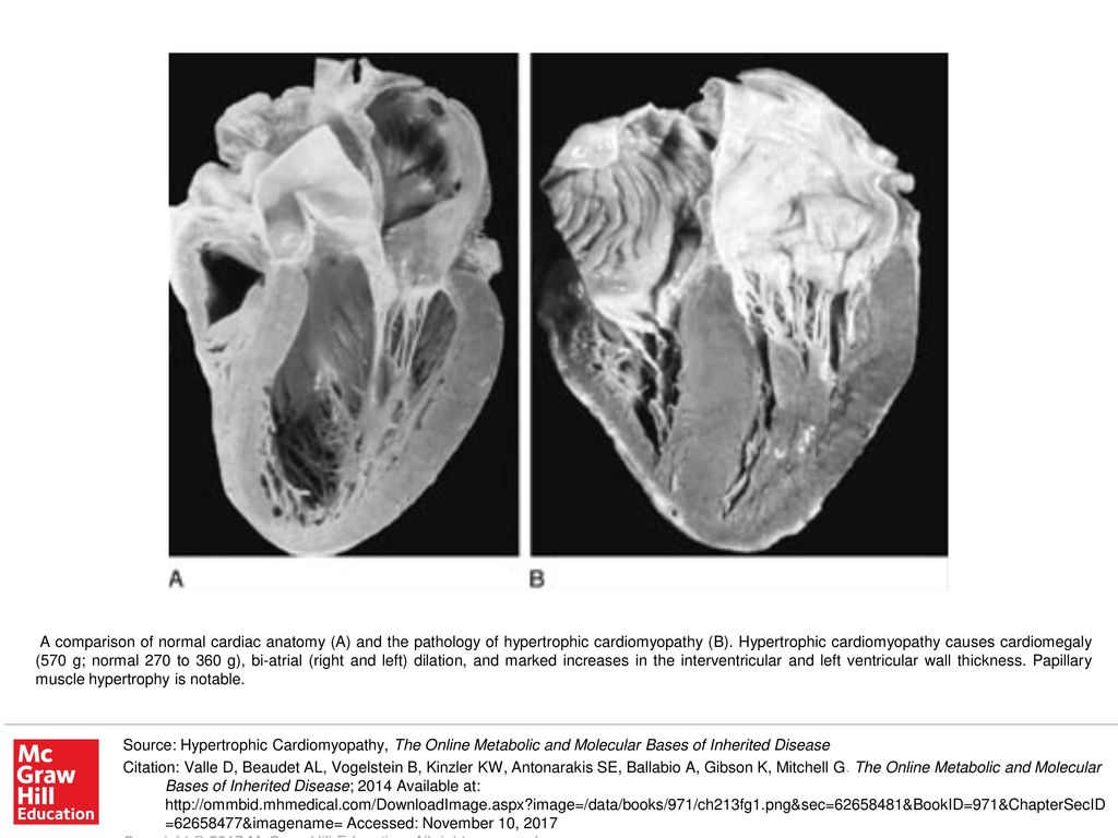 A Comparison Of Normal Cardiac Anatomy A And The Pathology Of