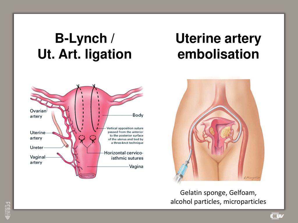 Uterine Artery Embolization For Postpartum Hemorrhage