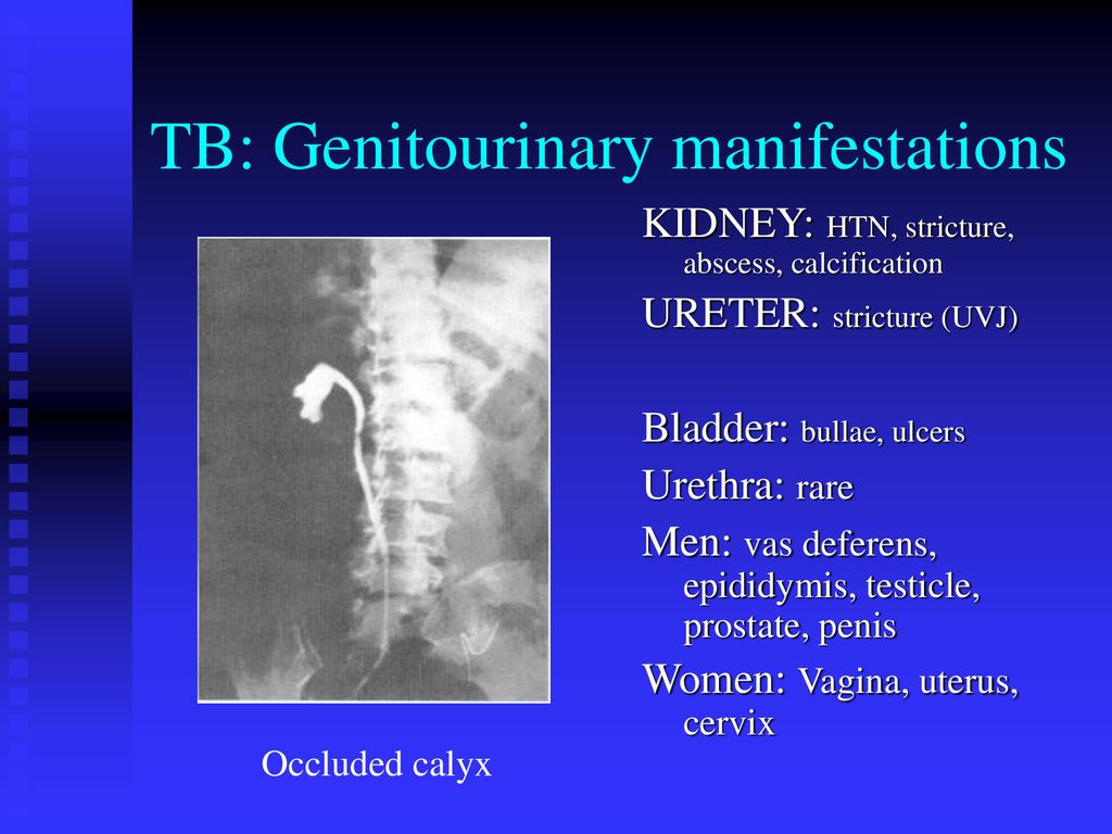 Genitourinary Tb Parasitic And Fungal Infections Ppt Download