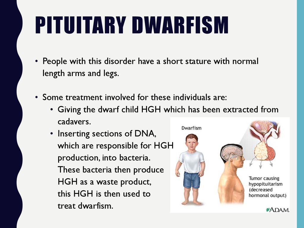 Pituitary Dwarfism People Pituitary Dwarfism People