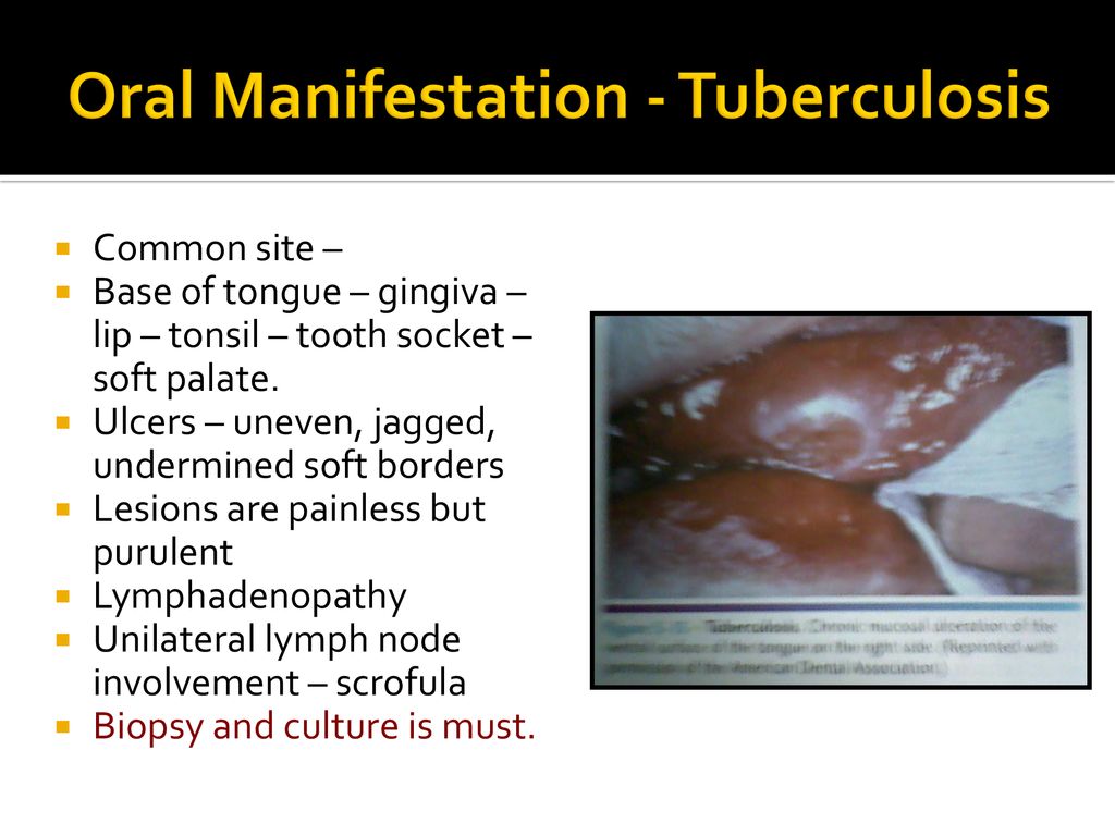 Bacterial Infections Of Oral Cavity 1 Ppt Download