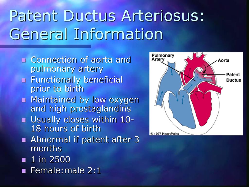 Patent Ductus Arteriosus Occlusion Device Ppt Download