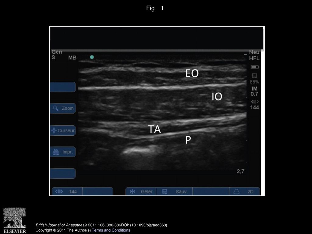 Comparison Between Ultrasound Guided Transversus Abdominis Plane And