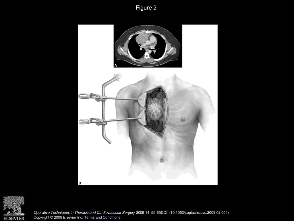 Technique Of Mediastinal Germ Cell Tumor Resection Ppt Download