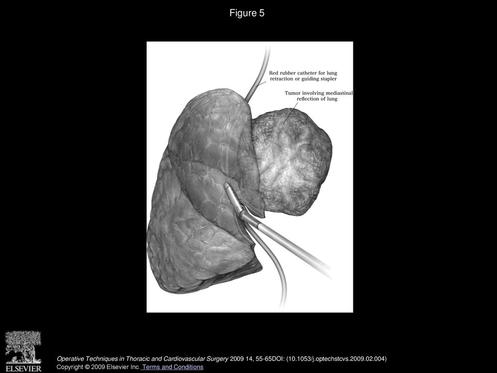 Technique Of Mediastinal Germ Cell Tumor Resection Ppt Download