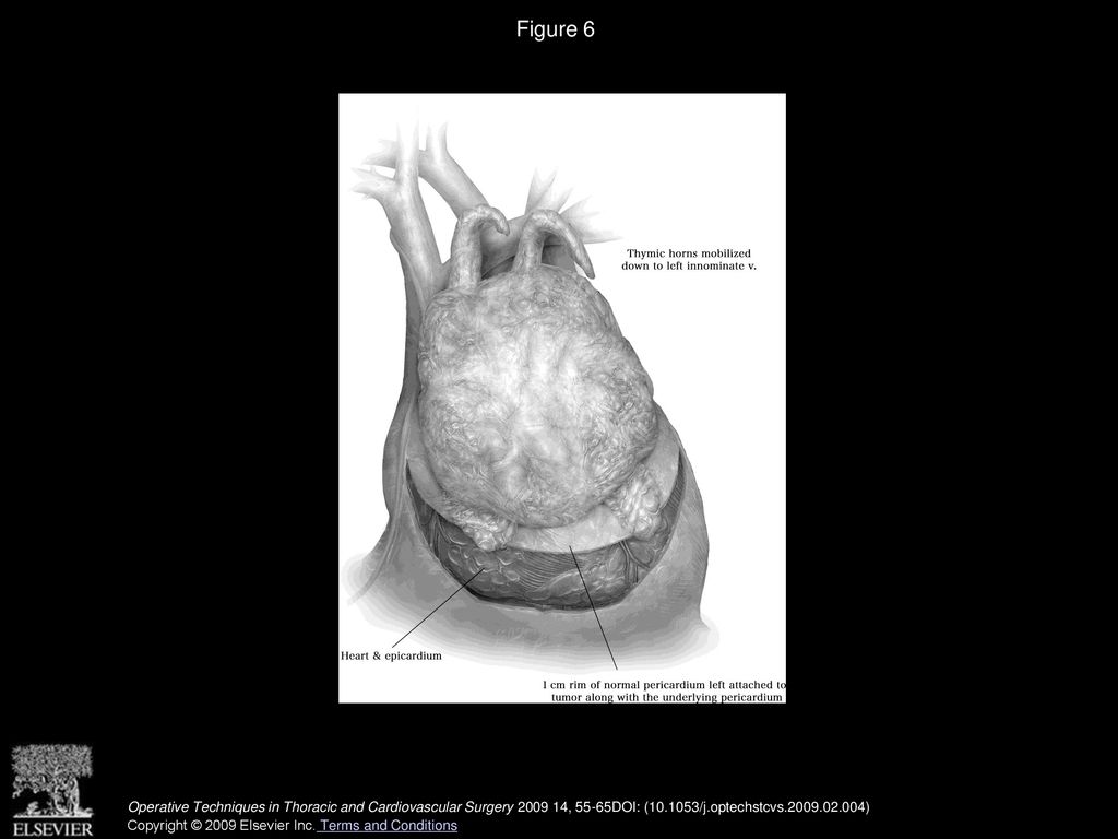 Technique Of Mediastinal Germ Cell Tumor Resection Ppt Download
