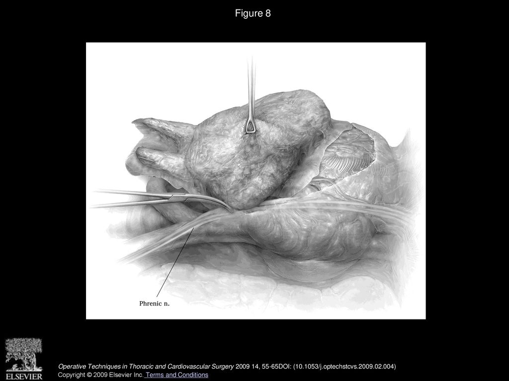 Technique Of Mediastinal Germ Cell Tumor Resection Ppt Download