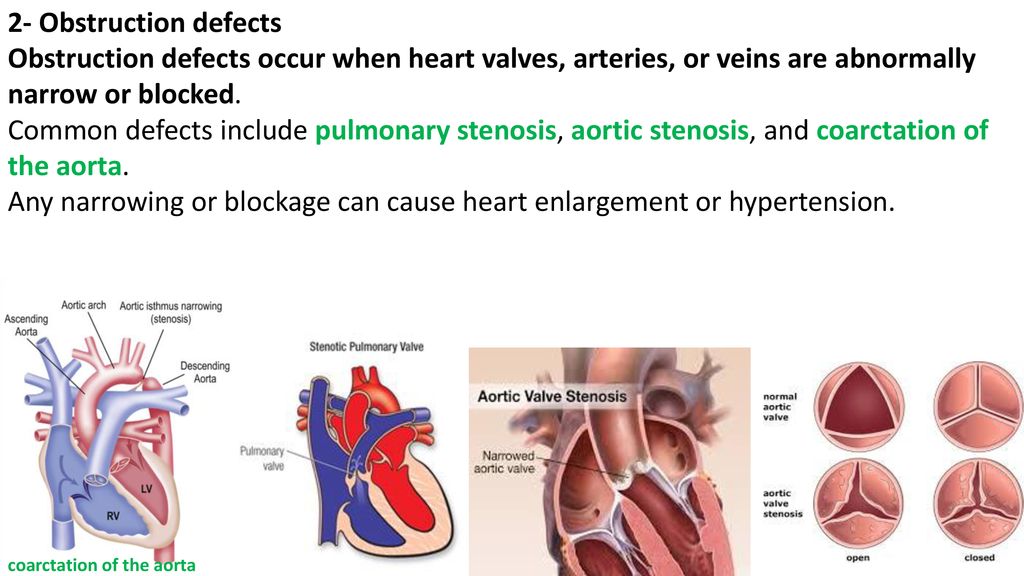 Congenital Heart Diseases Ppt Download