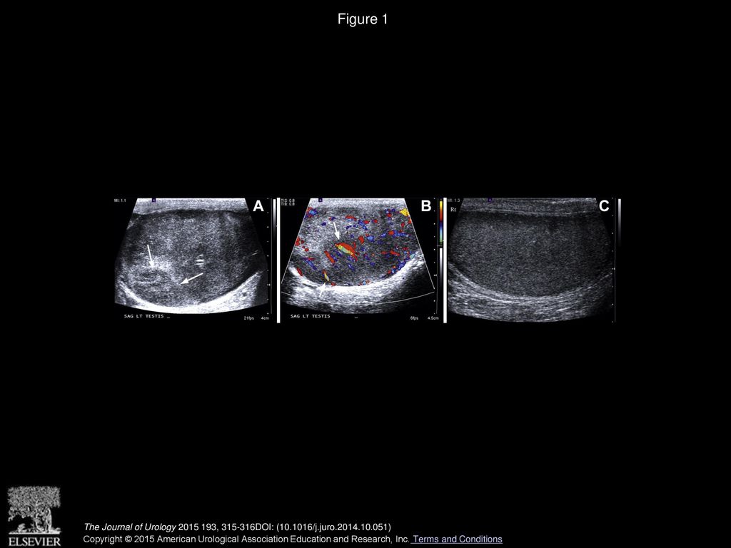 Primary Testicular Lymphoma Ppt Download