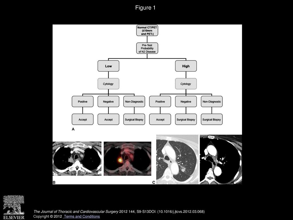 Endobronchial Ultrasonography Ebus —its Role In Staging Of Non Small