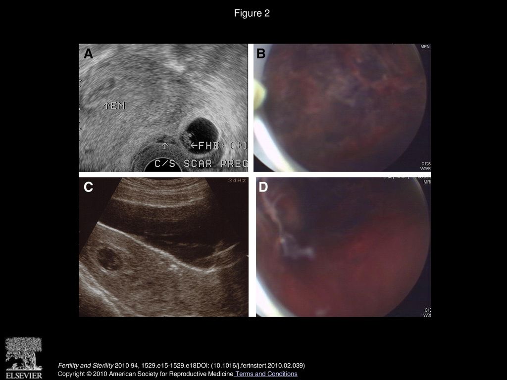 Hysteroscopic Management Of Heterotopic Cesarean Scar Pregnancy Ppt