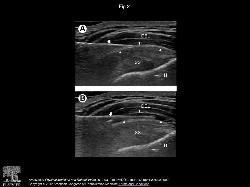 Subacromial Corticosteroid Injection On Poststroke Hemiplegic Shoulder