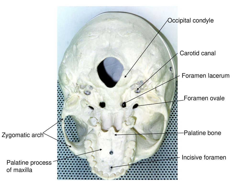 Foramen Lacerum Temporal Bone