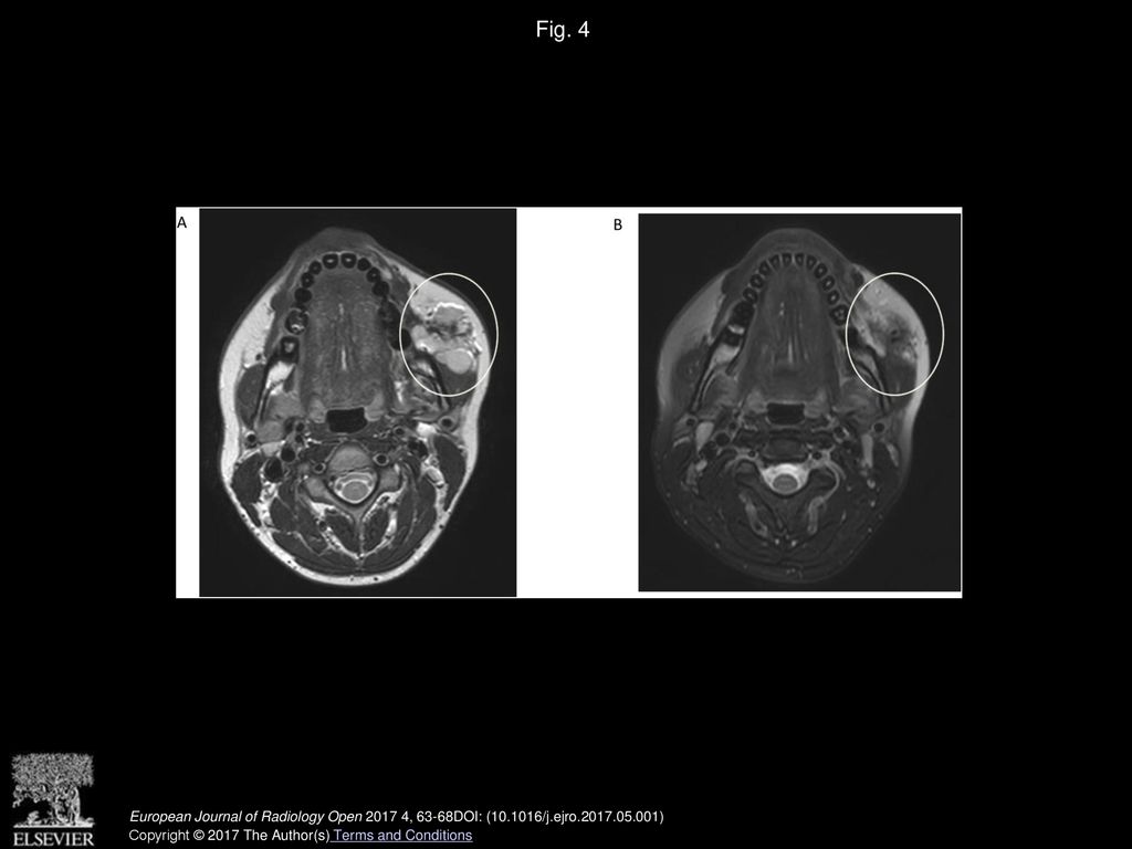 Interdisciplinary Management Of Head And Neck Vascular Anomalies