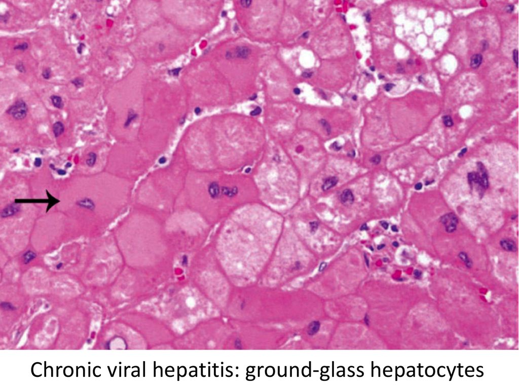 Hepatitis B Ground Glass Hepatocytes