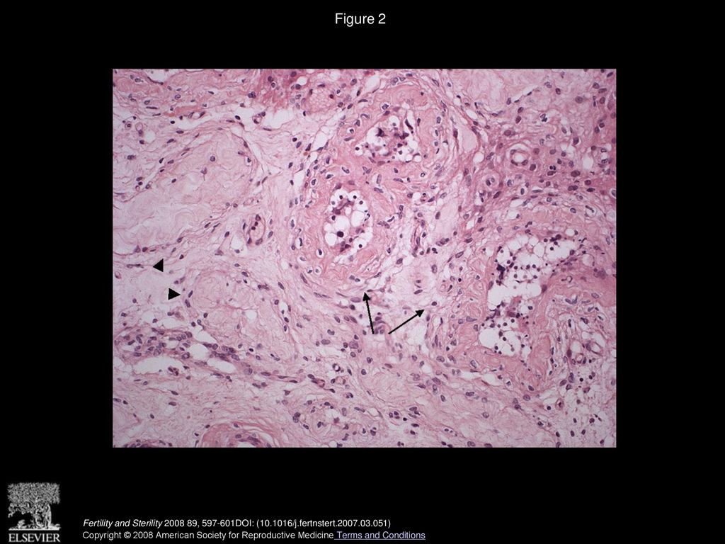 Testicular Adrenal Rest Tumors In Patients With Congenital Adrenal
