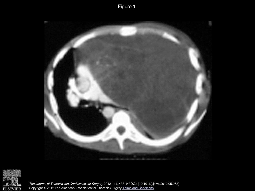 The “growing Teratoma Syndrome” In Primary Mediastinal Nonseminomatous