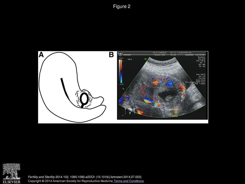 Outcomes Of Primary Surgical Evacuation During The First Trimester In