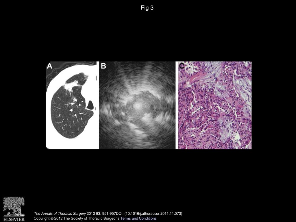 Endobronchial Ultrasonography With A Guide Sheath In The Diagnosis Of