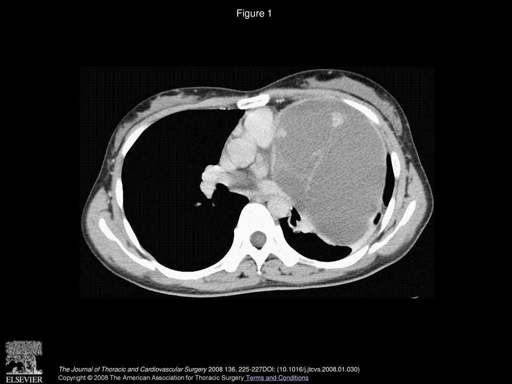 Teratoma With Malignant Transformation In The Anterior Mediastinum