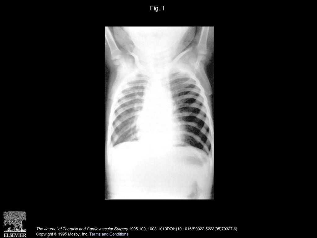 Bronchogenic Cysts Of The Mediastinum Ppt Download