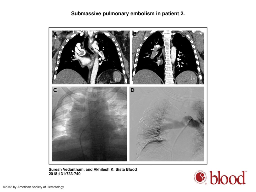 Submassive Pulmonary Embolism In Patient Ppt Download