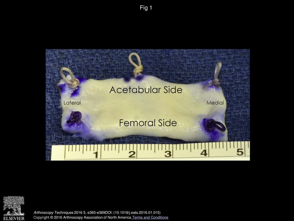 Hip Capsular Reconstruction Using Dermal Allograft Ppt Download