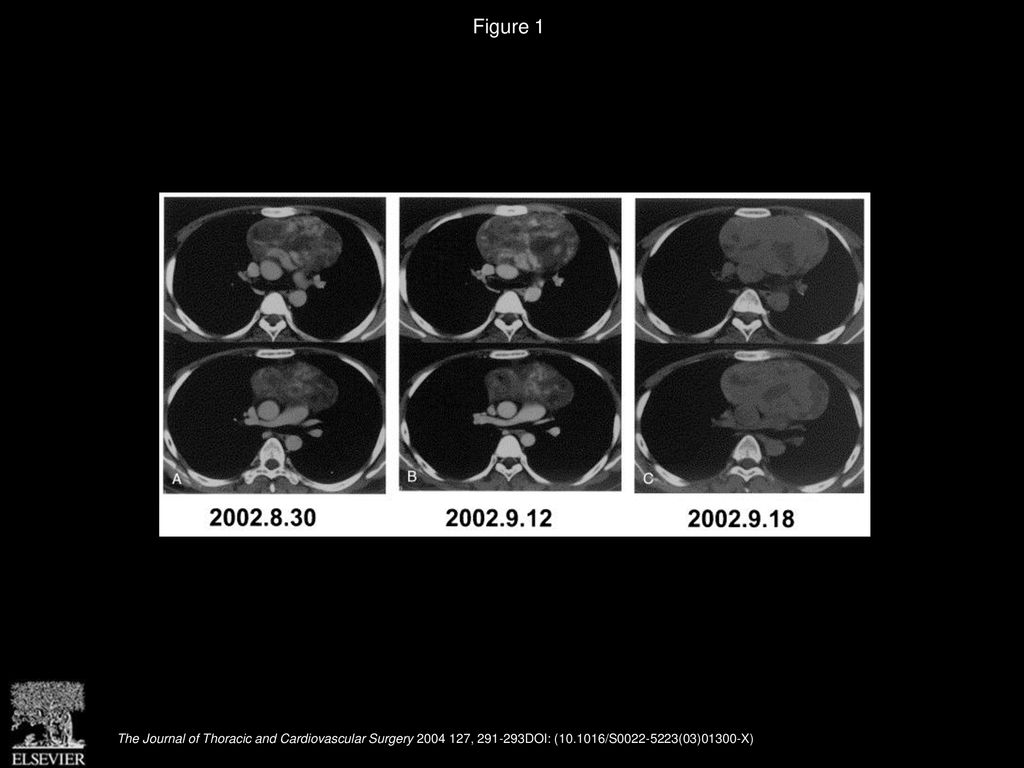 Mediastinal Growing Teratoma Syndrome After Cisplatin Based