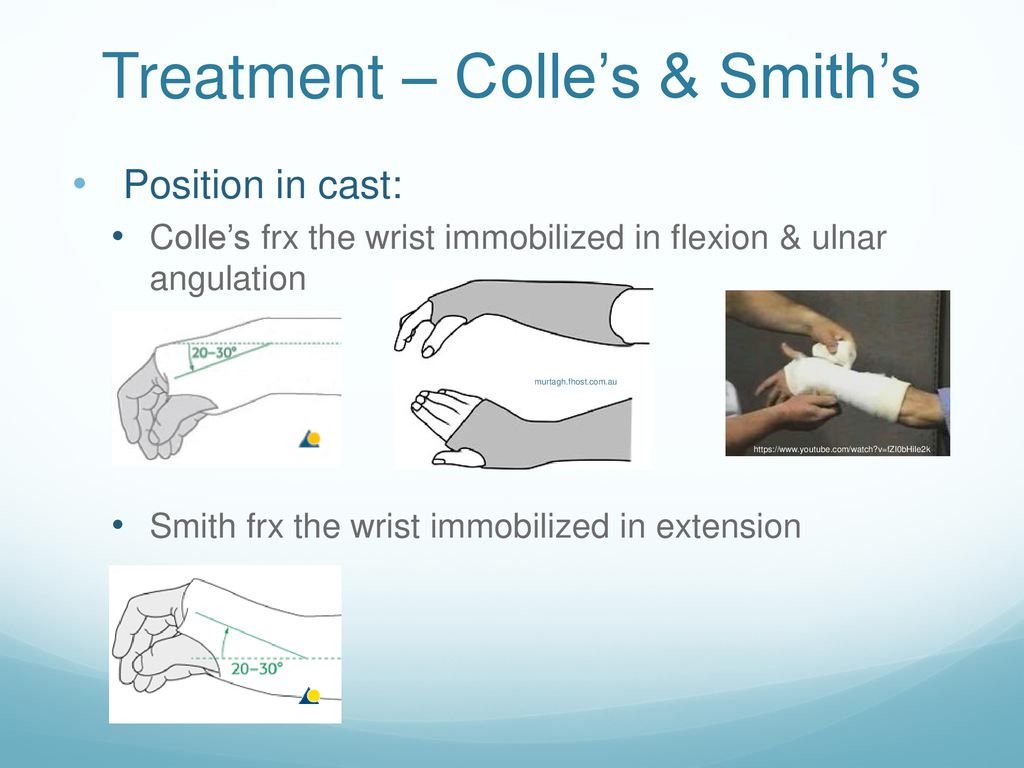 Smith Fracture Cast