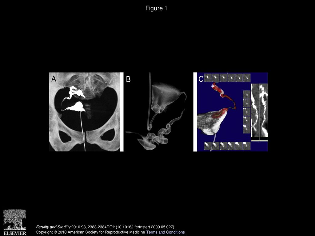 Virtual Hysterosalpingography And Hysteroscopy Assessment Of Uterine