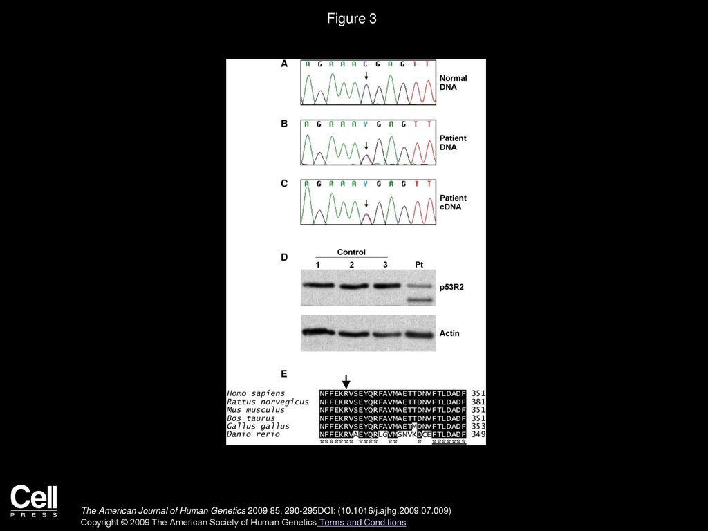A Heterozygous Truncating Mutation In Rrm2b Causes Autosomal Dominant