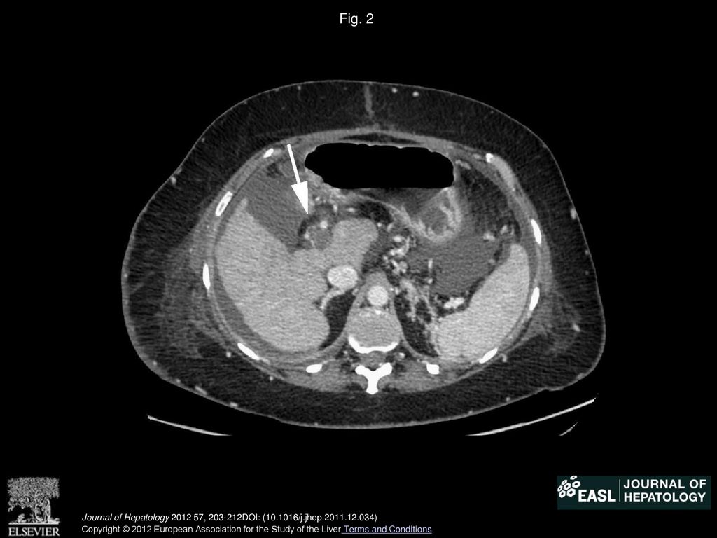 Portal Vein Thrombosis Cirrhosis And Liver Transplantation Ppt Download