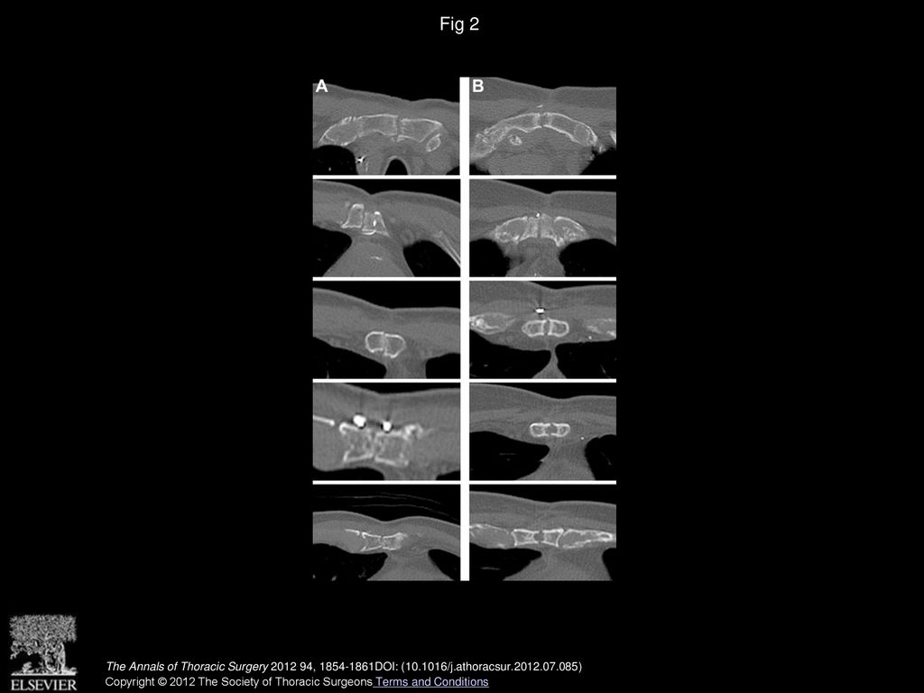 Sternal Closure With Rigid Plate Fixation Versus Wire Closure A