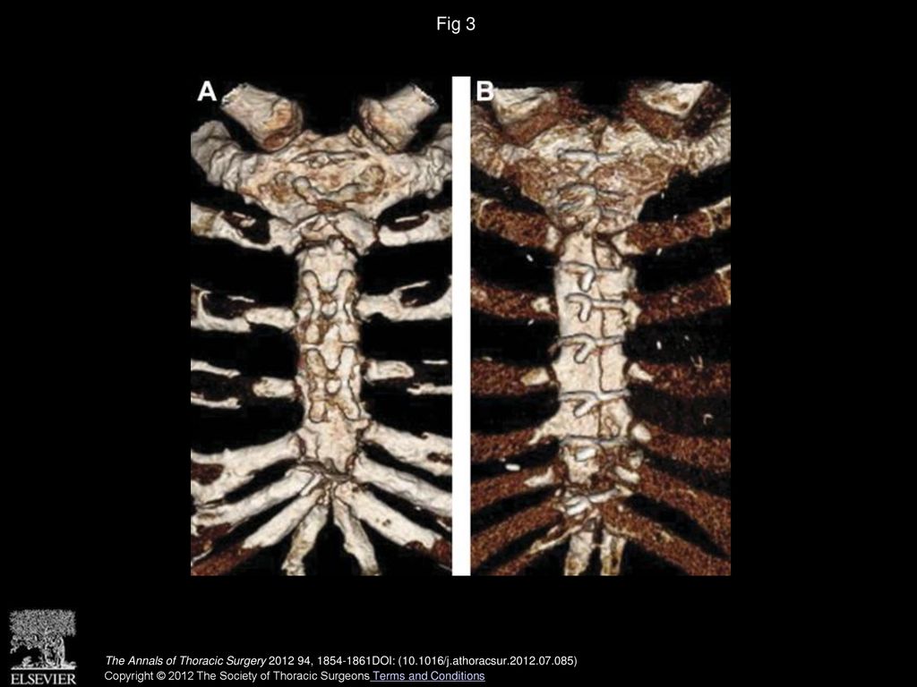 Sternal Closure With Rigid Plate Fixation Versus Wire Closure A