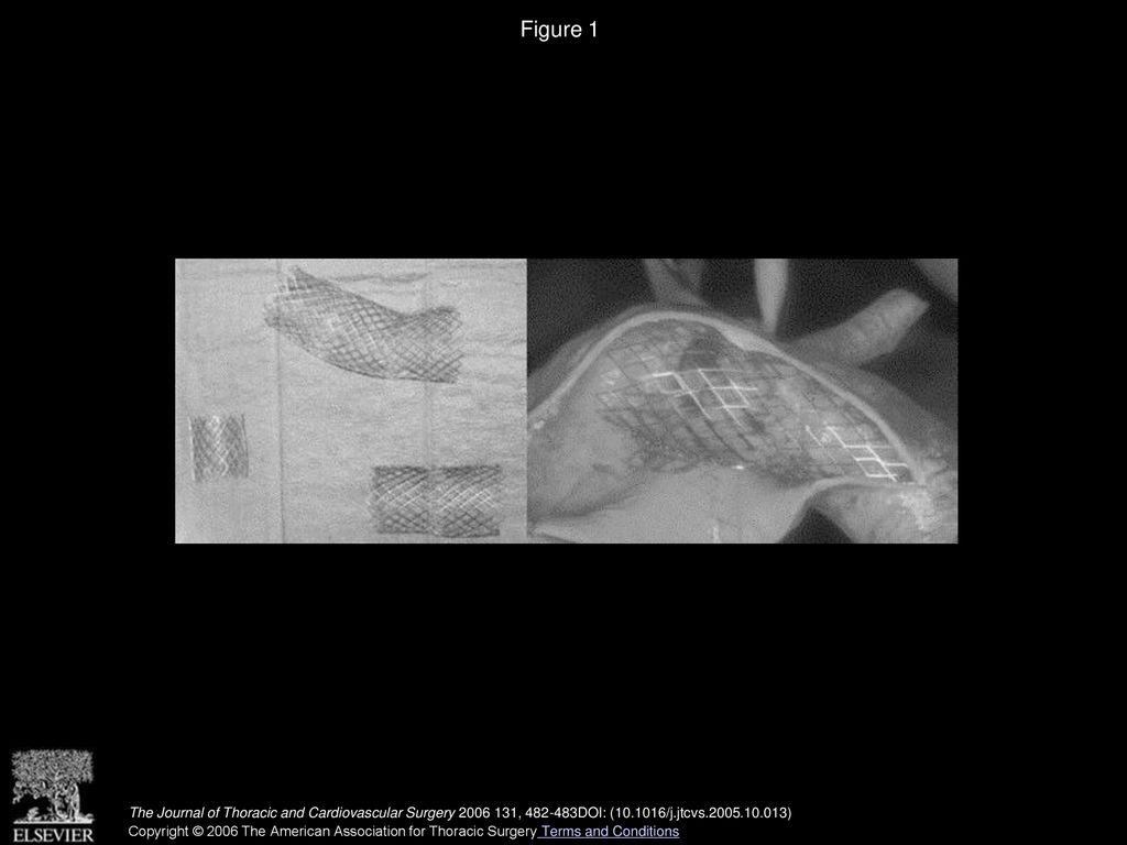 Type A Aortic Dissection New Surgical Strategy Using Intra Operative