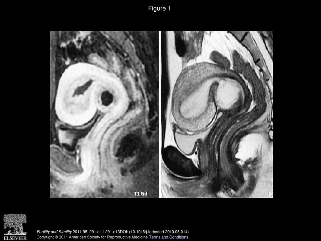 A Very Rare Case Of An Ectopic Cervical Intramural Pregnancy Ppt Download