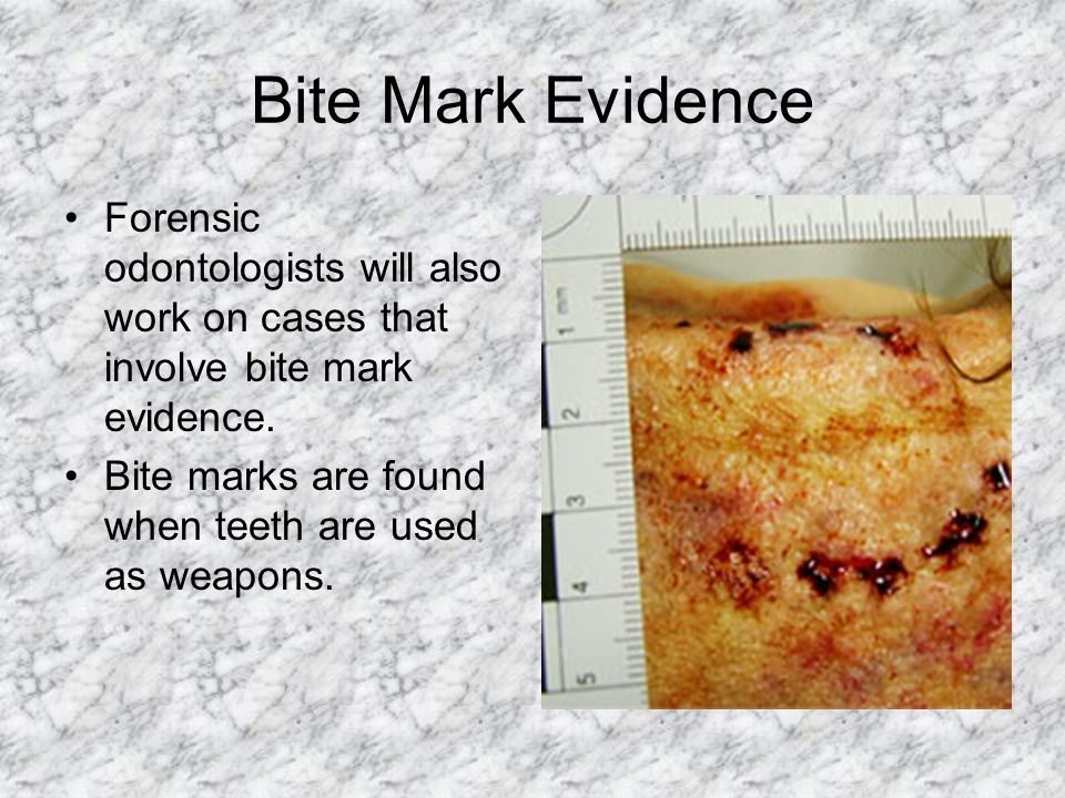 Ted Bundy Bite Mark