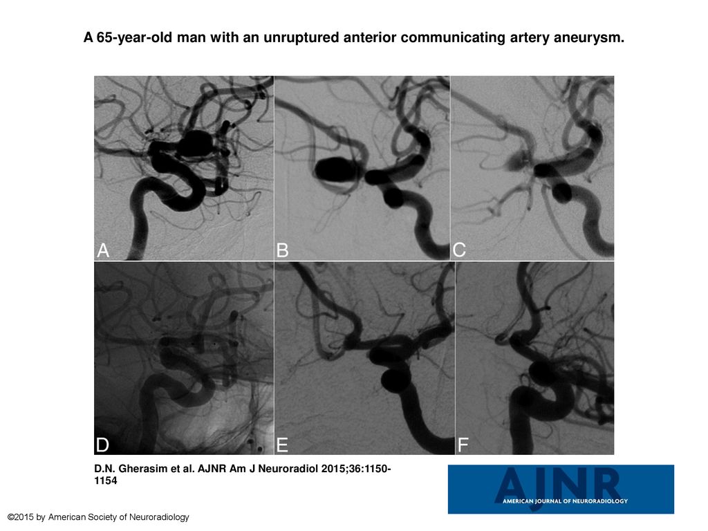 A 65 Year Old Man With An Unruptured Anterior Communicating Artery