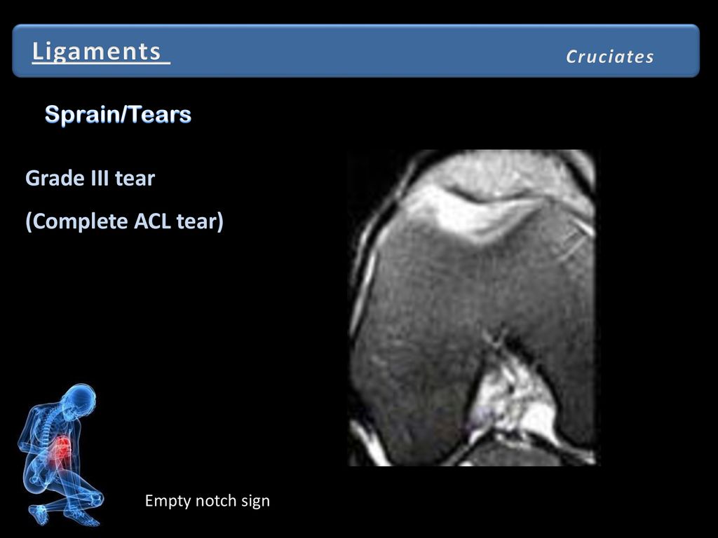 Mri Knee Ppt Download