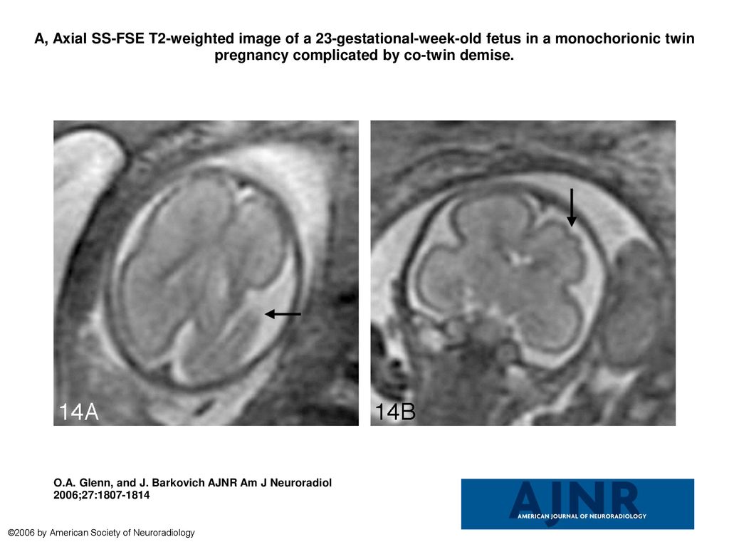 A Axial Ss Fse T2 Weighted Image Of A 23 Gestational Week Old Fetus In